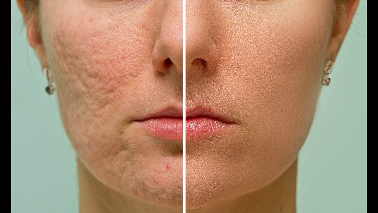 Cara mudah hilangkan Bopeng / Easy way to remove Acne scars [Photoshop ...