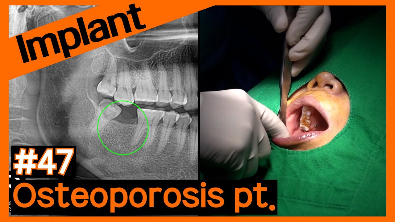 [Online Surgery] MTM for implant prosthodontics using mini screws in ...