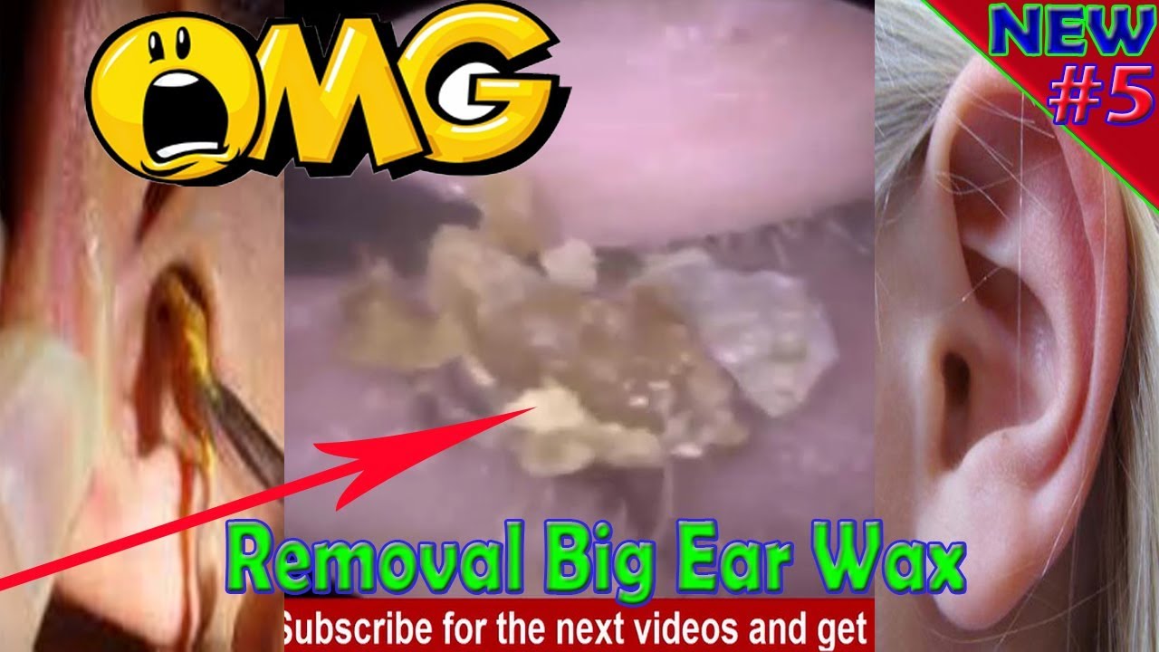 Fire ear wax removal - lopersperu