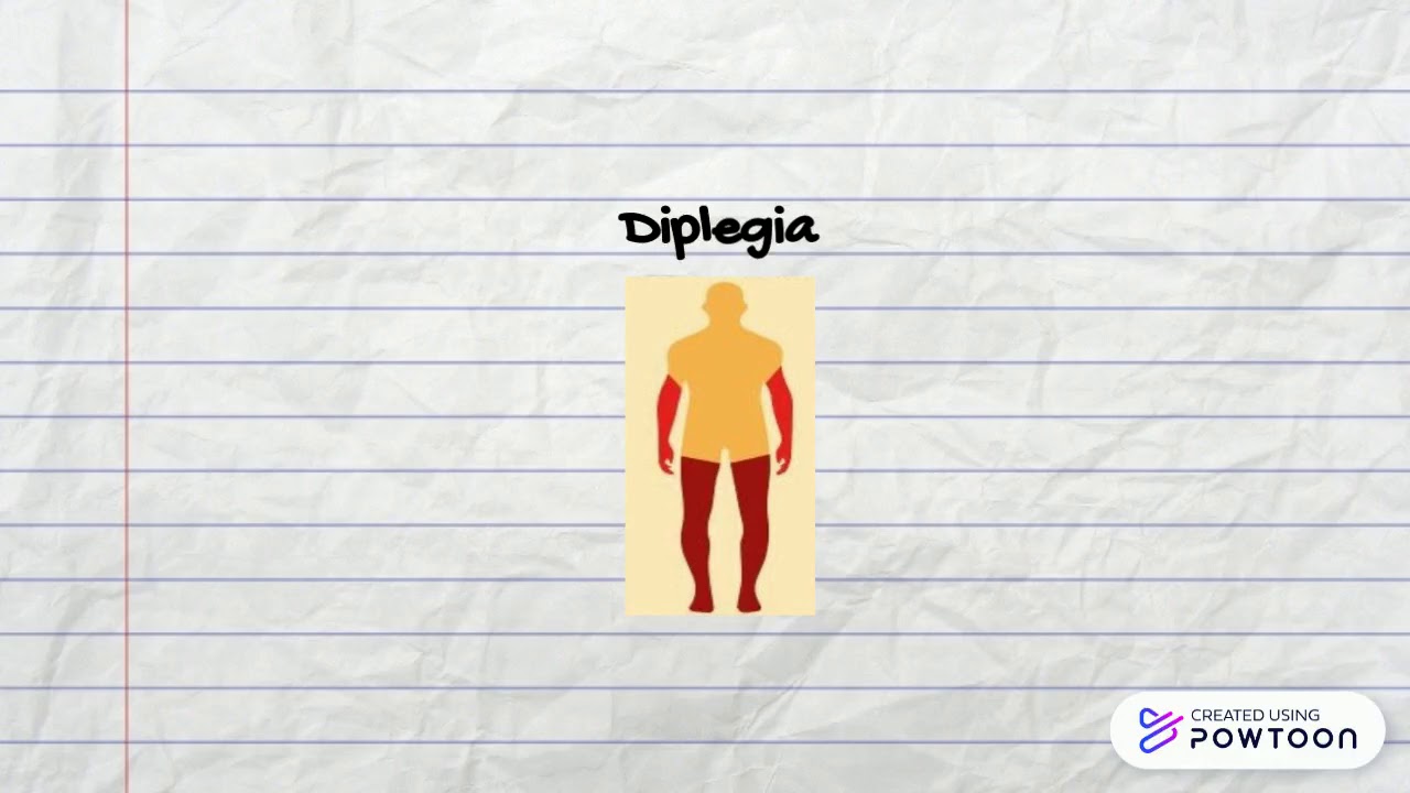 diplegia CP - YouTube