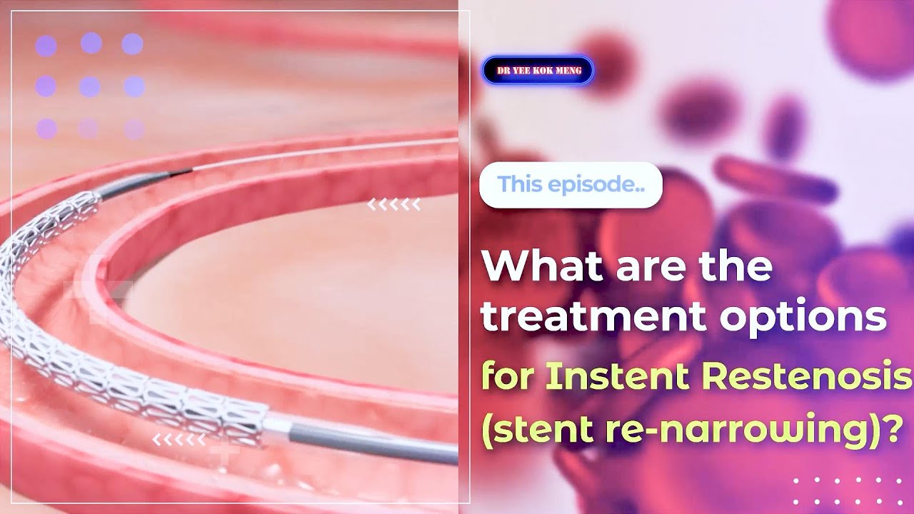 What are the treatment options for Instent Restenosis (stent re ...