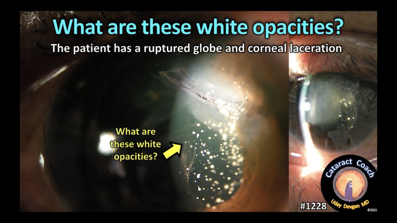 CataractCoach 1228: ruptured globe injury with white opacities - YouTube