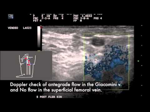 Compensating flow in the Giacomini vein in a case of Superficial ...