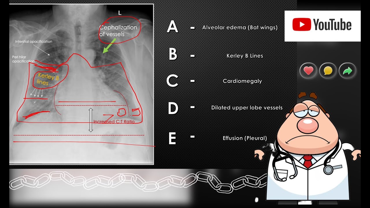 Congestive Heart Failure on Chest X-Ray: All Key Findings Explained ...