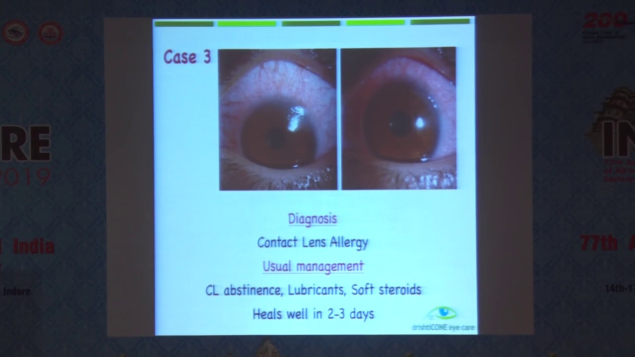 AIOC2019 GP18 Topic Peripheral corneal infiltrates Differential ...
