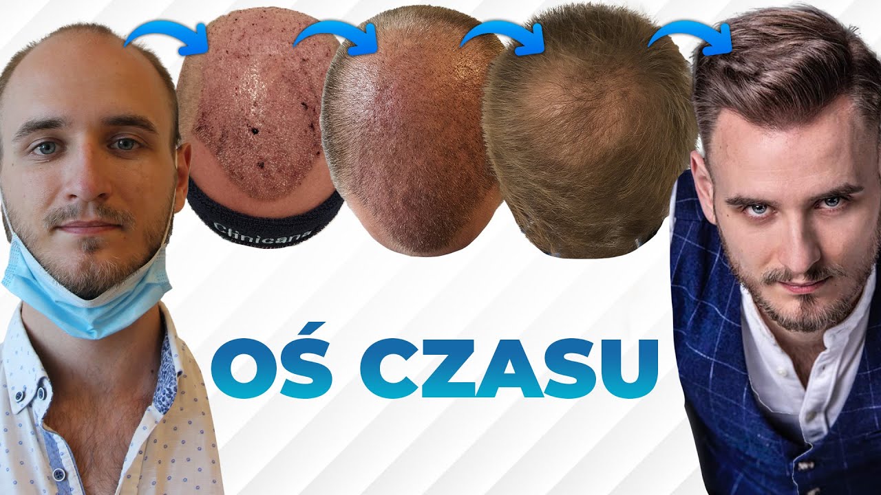 Rekonwalescencja Po Przeszczepie Włosów | Oś czasu - YouTube
