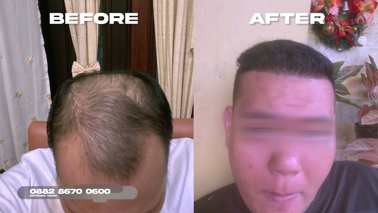 TANAM RAMBUT AMAN DAN BAHAGIA DENGAN ESTRADA TEAM - YouTube