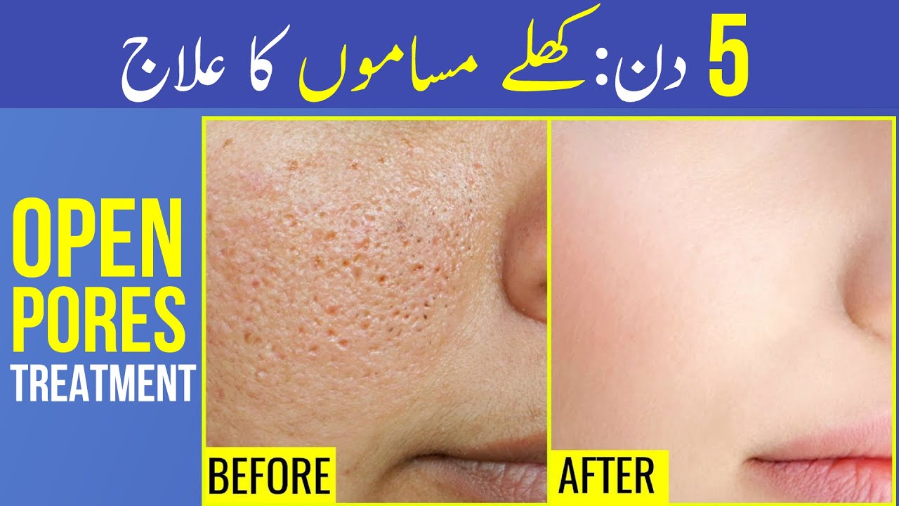 Khule Masam Band Karne Ka Tarika Open Pores Treatment Open Pores Ka