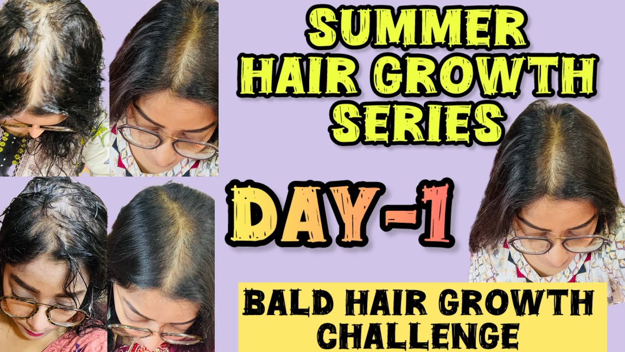 Bald Hair Growth Challenge🧑‍🦲Day-1 of Summer Hair Growth Series👍#bald# ...
