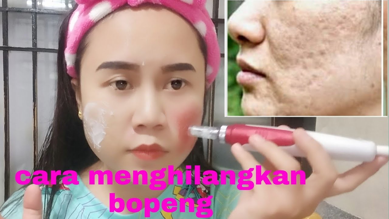 Cara menghilangkan scar atau bopeng bekas jerawat menggunakan Alat ...