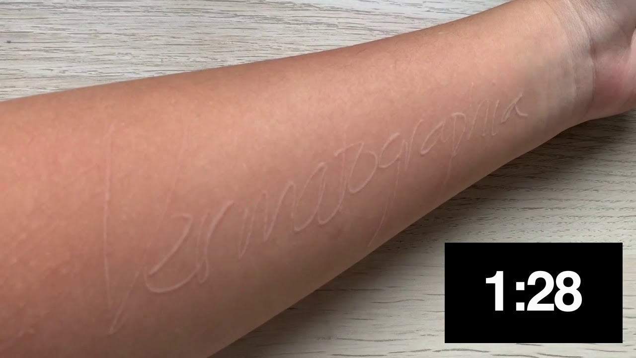 [DERMATOGRAPHIA] Real Time Dermatographia (what it looks like for me ...