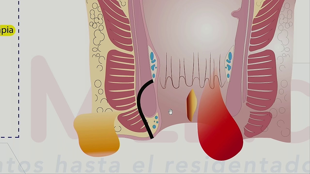 Cirugía General - Patología anorrectal - Dr. William Guzman - YouTube