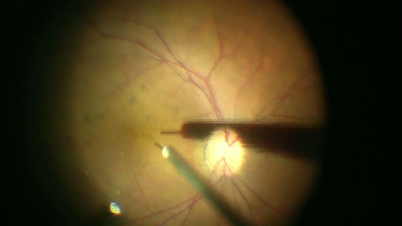 Αφαιρεση PFCL απο τον υπαμφιβληστροειδικο χωρο subretinal PFCL ...