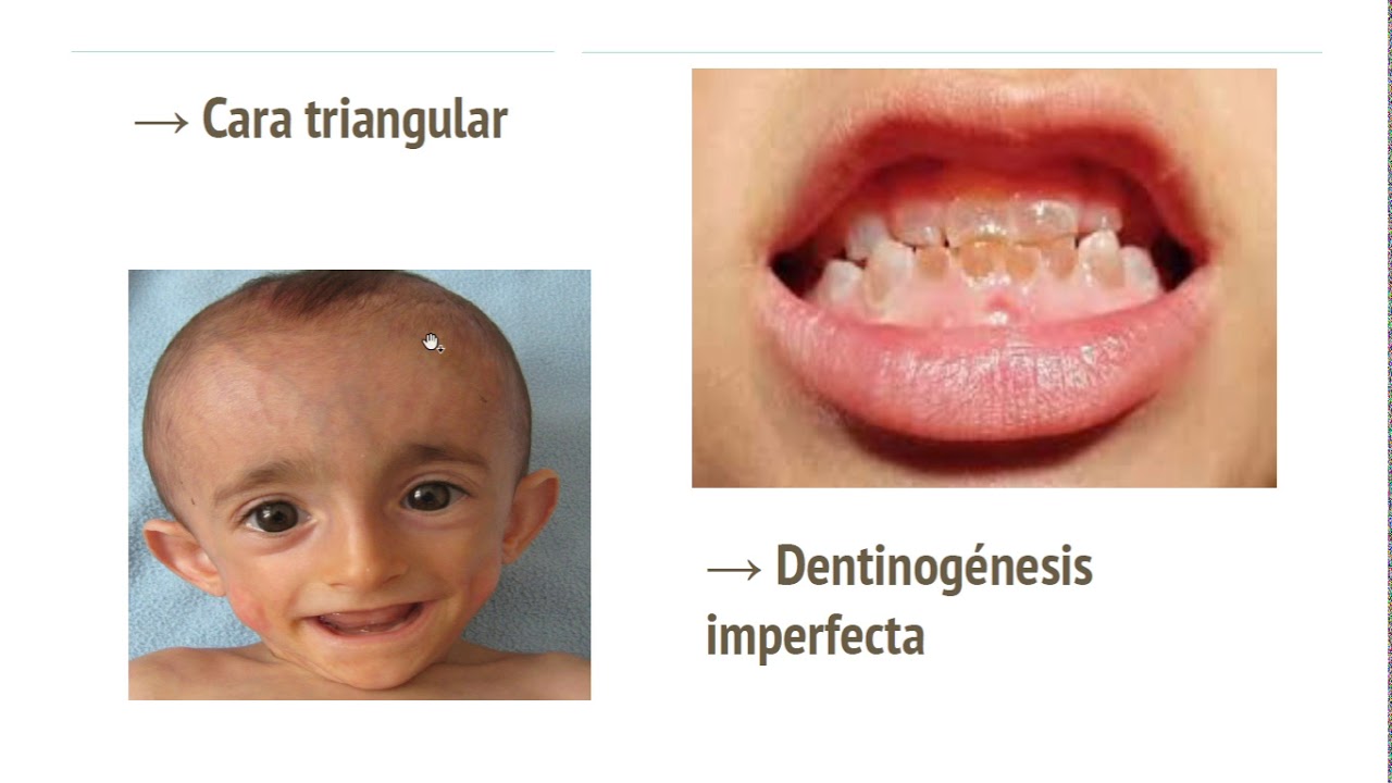 OSTEOGENESIS IMPERFECTA - ENFERMEDAD DE LOS HUESOS DE CRISTAL - YouTube