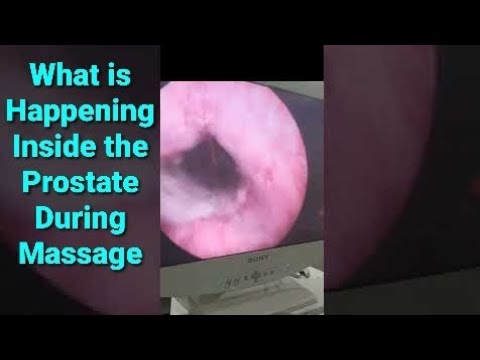 Istanbul Protocol for Chronic Prostatitis - YouTube