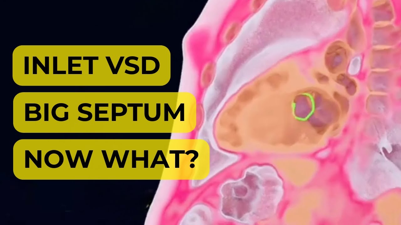 DORV with Inlet VSD and Large Conal Septum – Baffle Repair by Dr ...