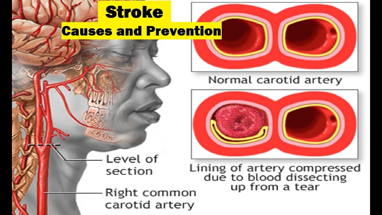 Stroke : Causes and prevention - YouTube