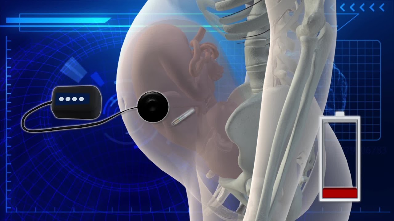 Fetal pacemaker to begin human trials - YouTube