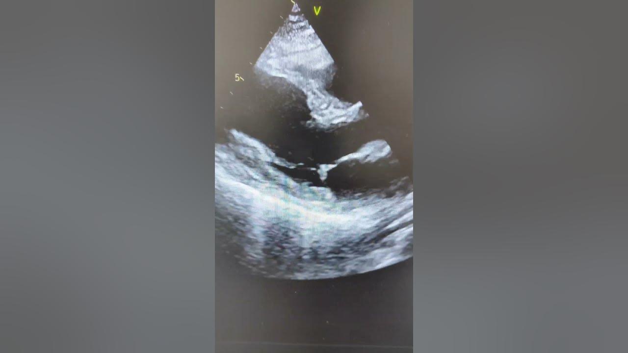 AWMI CAD RWMA in LAD territory echo with colour doppler 2D echo - YouTube