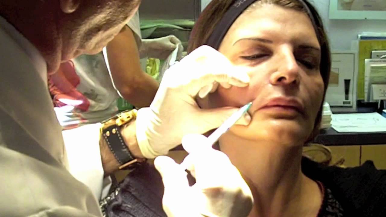 Radiesse Live Injection - Dr. Nissan Pilest (Irvine, CA) - YouTube