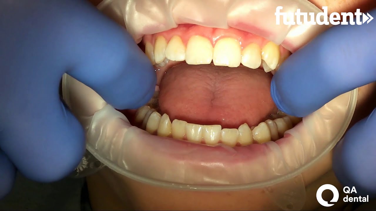 OptraGate insertion - YouTube