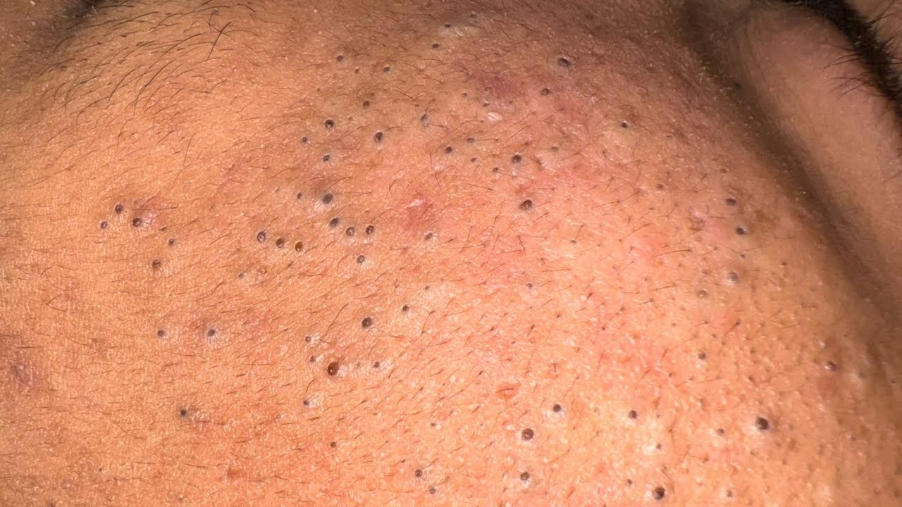 Satisfying Pimple Extraction — Deep Facial Cleansing and Skincare ...