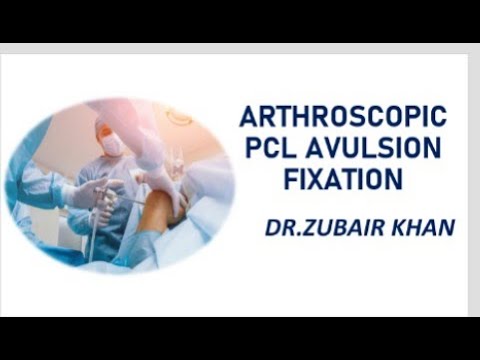 ARTHROSCOPIC PCL AVULSION FIXATION- by DR.ZUBAIR KHAN - YouTube