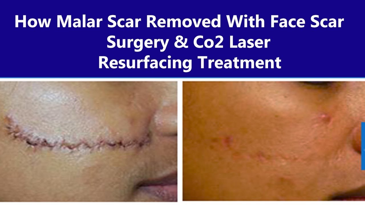W-Plasty & Co2 Laser Resurfacing For Removing Malar Scar | The Esthetic ...