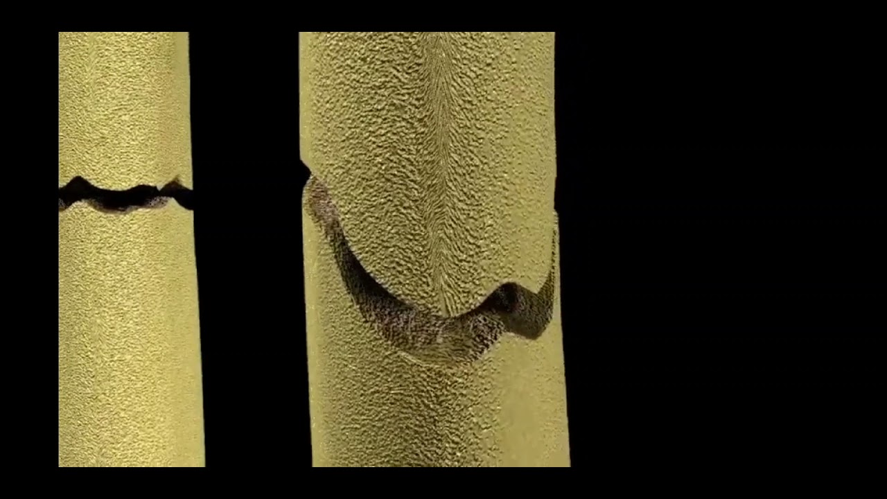 bone fracture patterns I classification of fractures (#orthopedics # ...