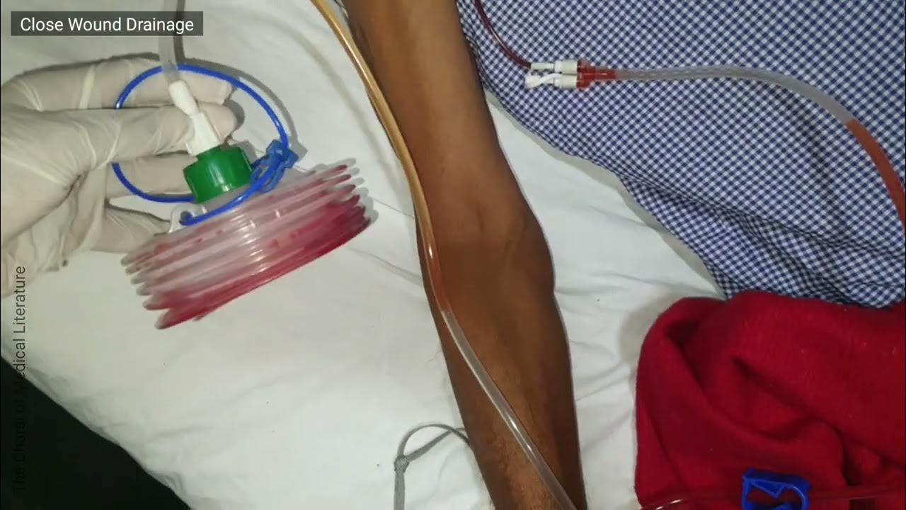 Close Wound Drainage | Romovac Drain - YouTube