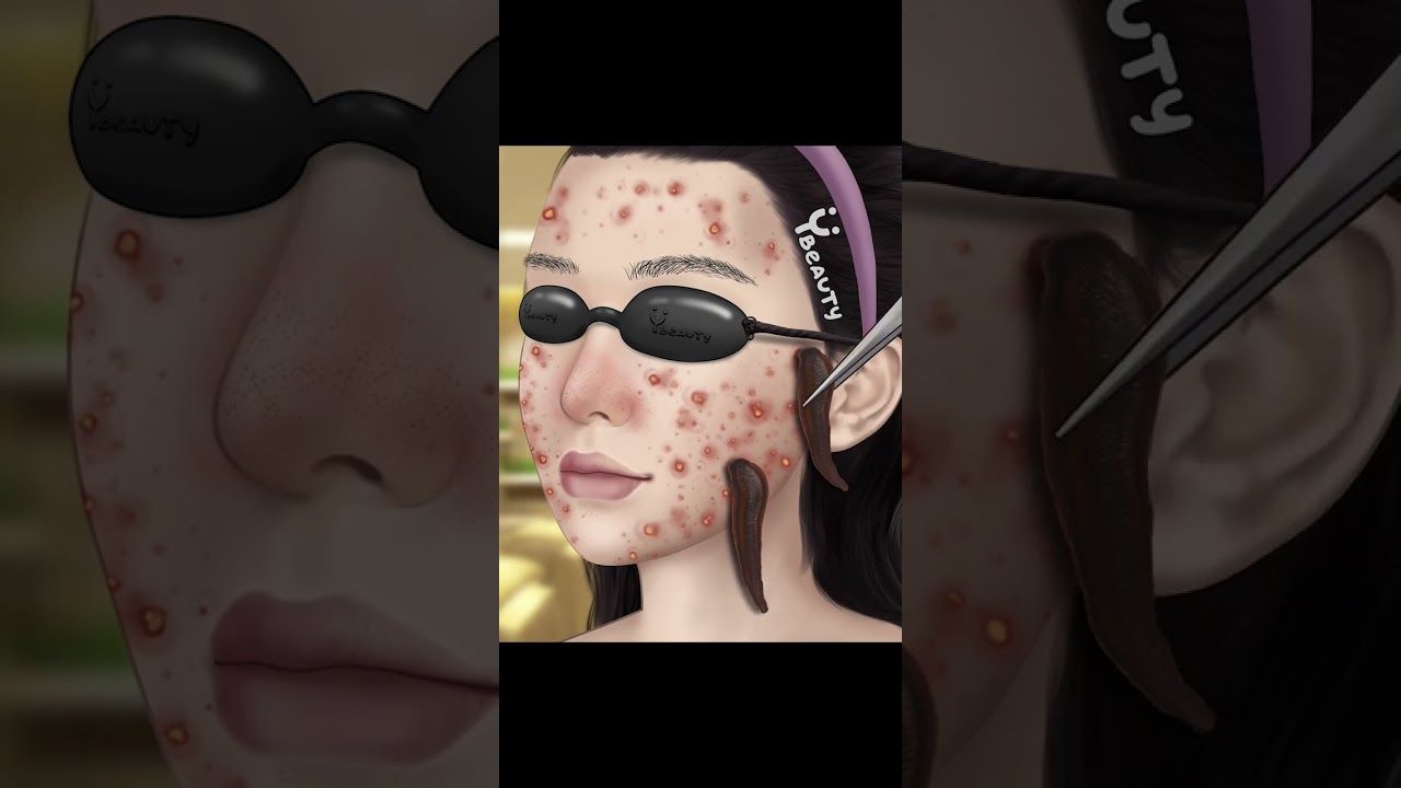 Unbelievable! The Girl Using Leeches Treat Acne |거머리로 여드름 치료하기 ...