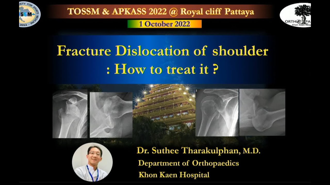 Fracture dislocation of the shoulder - How to treat it - YouTube