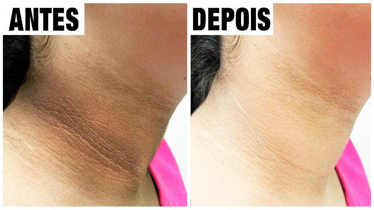Como Clarear Qualquer Mancha de Pele (Melasma/Axila/Virilha/Espinha ...