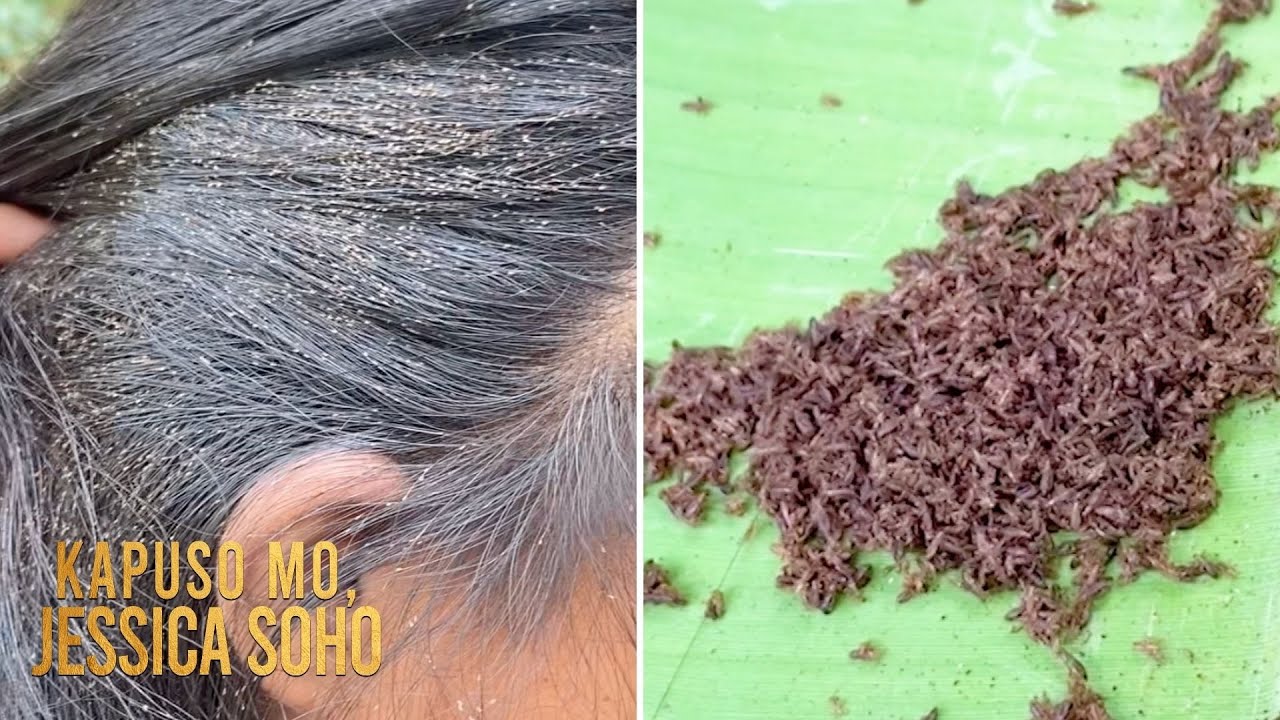 Sandamakmak na kuto, namamahay sa ulo ng 13-anyos na babae | Kapuso Mo ...