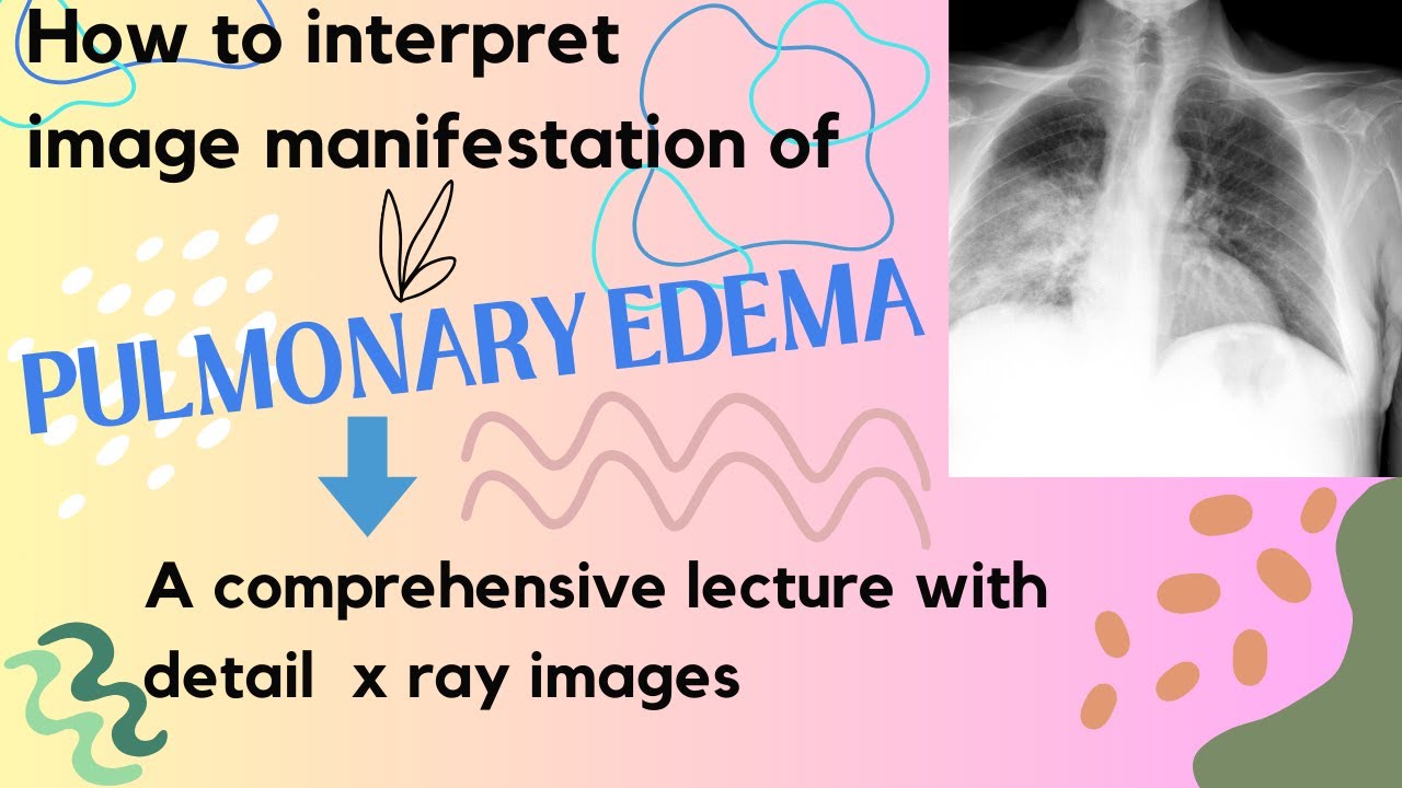 Pulmonary edema Xrays manifestation II How Edema fluid can be diagnosed ...
