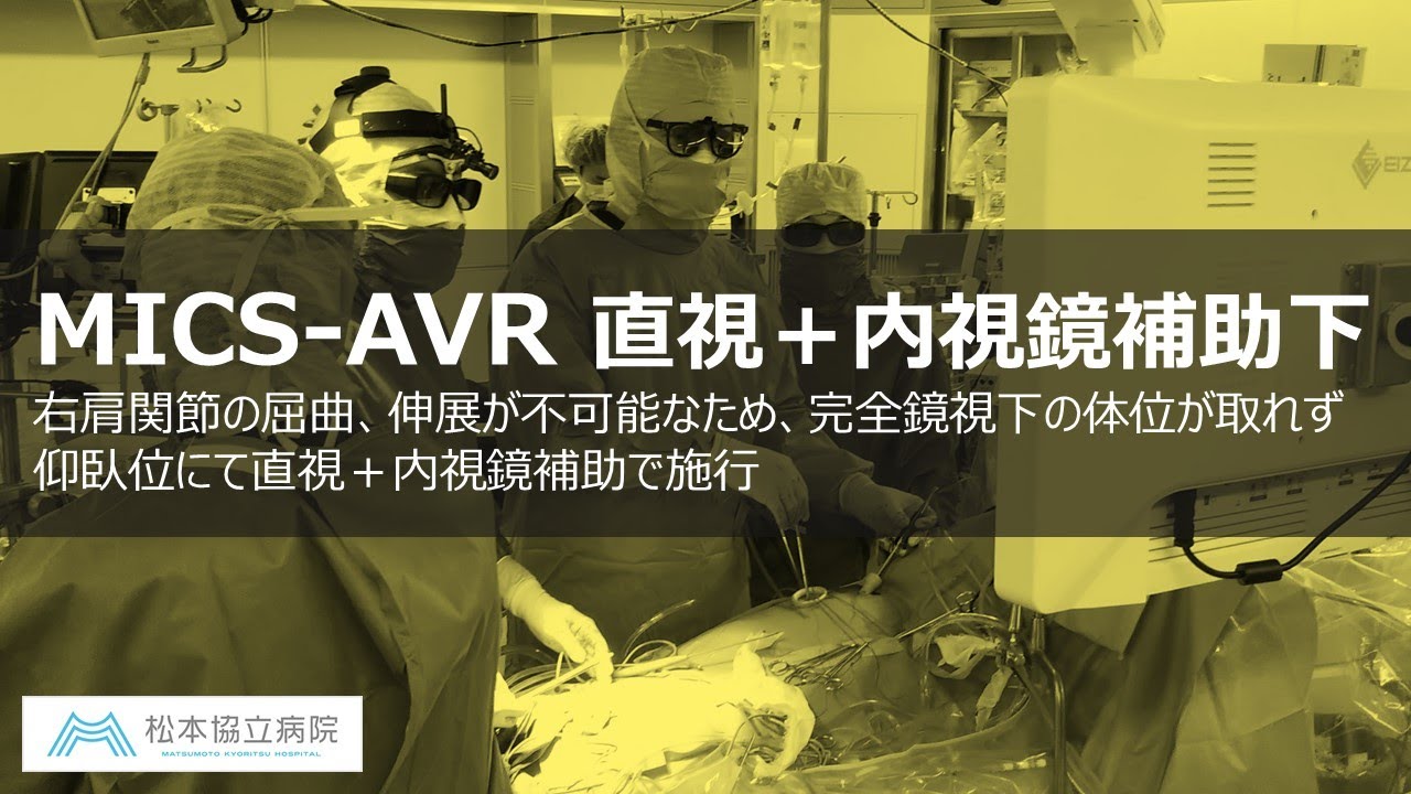 MICS-AVR （直視＋内視鏡補助下で施行） - YouTube