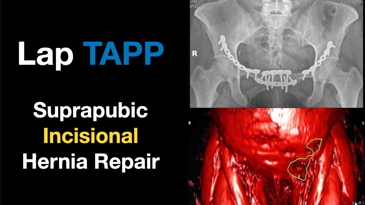 Lap TAPP for suprapubic incisional hernia after orthopedic surgery ...