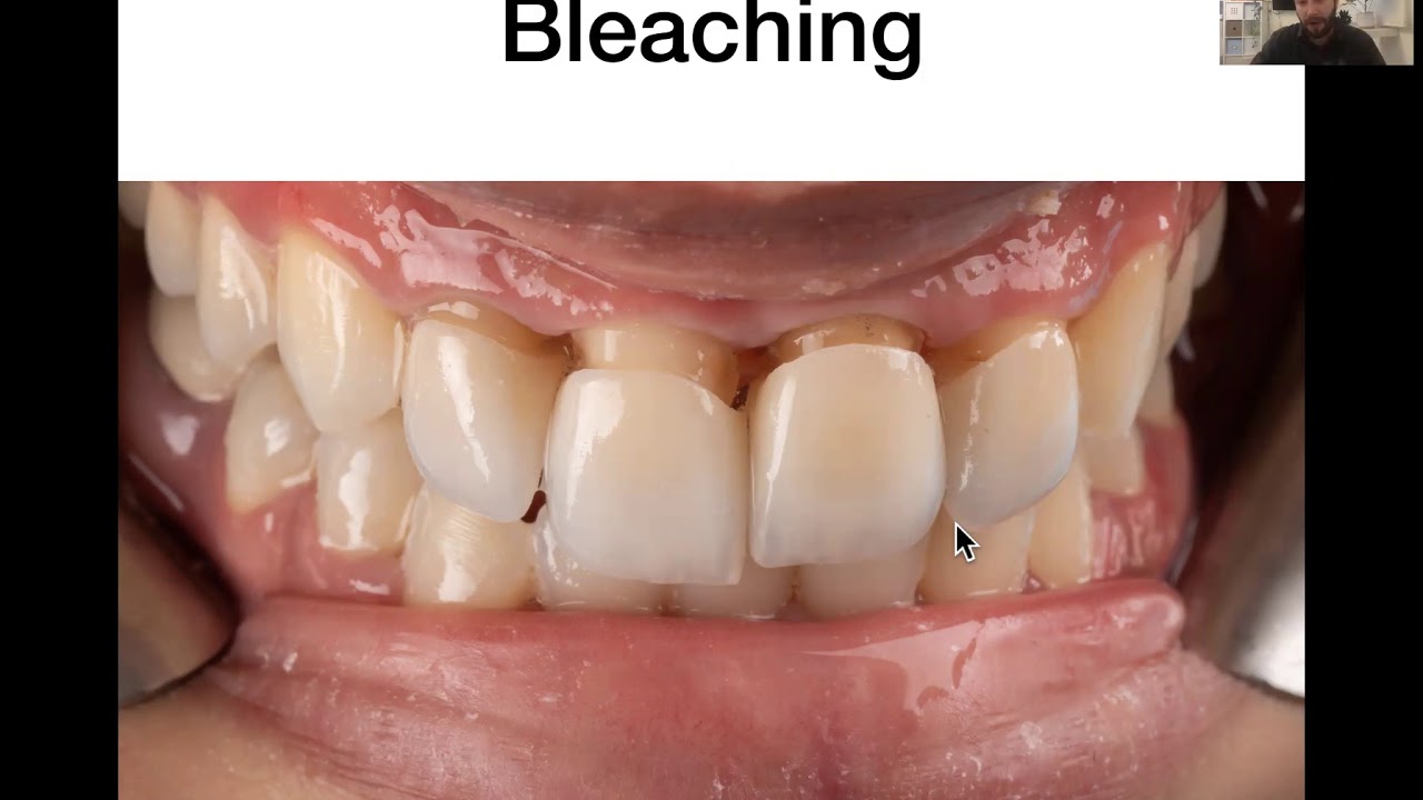 Part 1 of 3 Dental Veneers Case Selection And Planning - YouTube