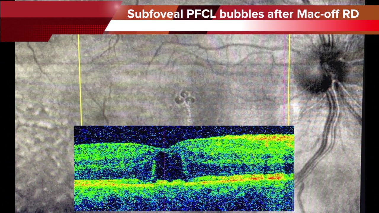 The insidious PFCL subretinal bubbles - YouTube