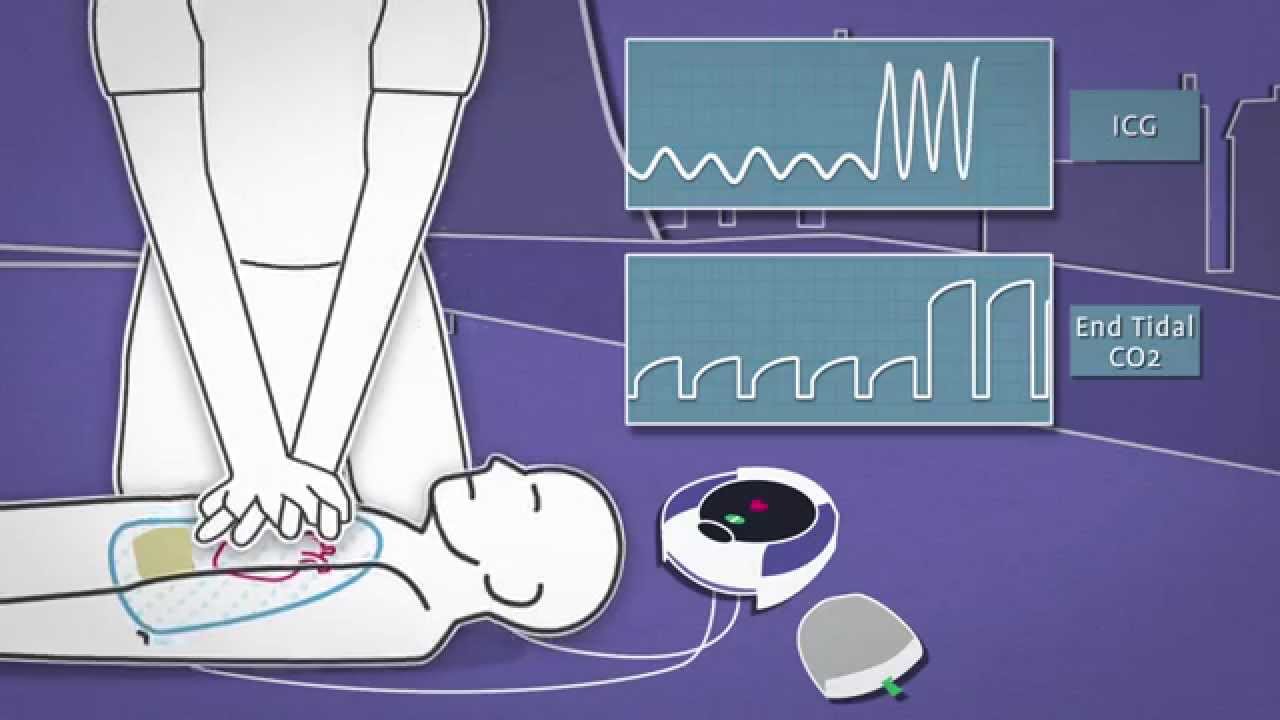 HeartSine's Advanced CPR Advisor™ Technology - YouTube
