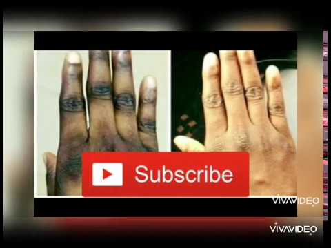 comment éliminer les taches sombres sur les doigts (phalanges noires)?