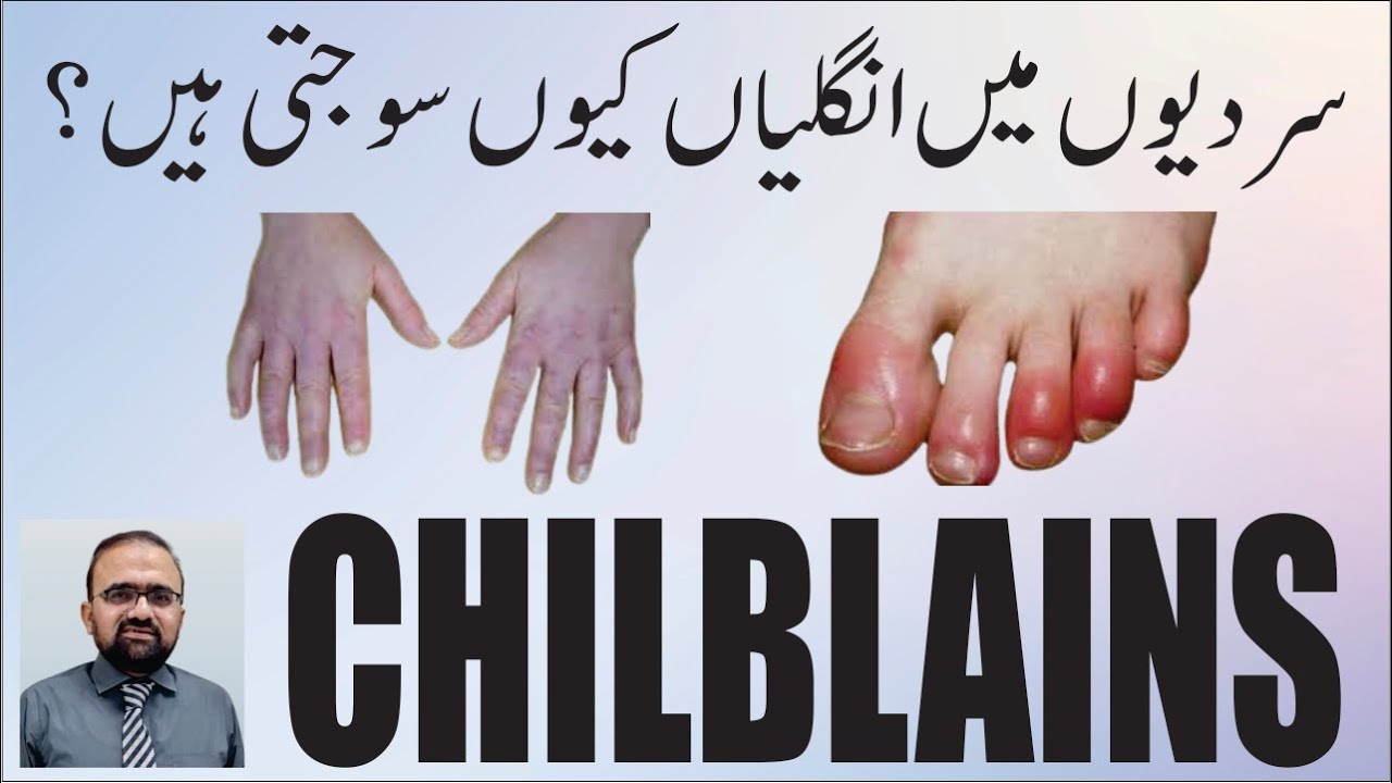 Chilblains - Swollen, Red & Painful Fingers In Winters - YouTube
