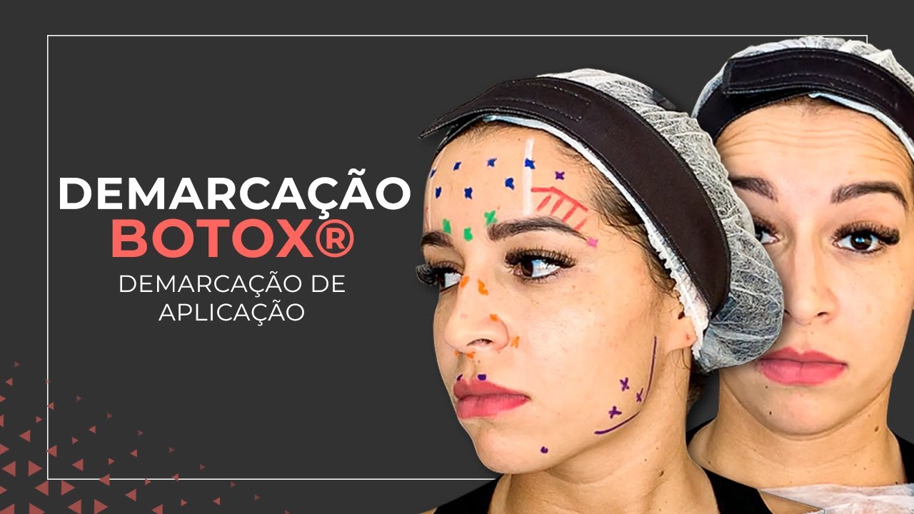 DEMARCAÇÃO TOXINA BOTULÍNICA - ÁREAS DE APLICAÇÃO - YouTube