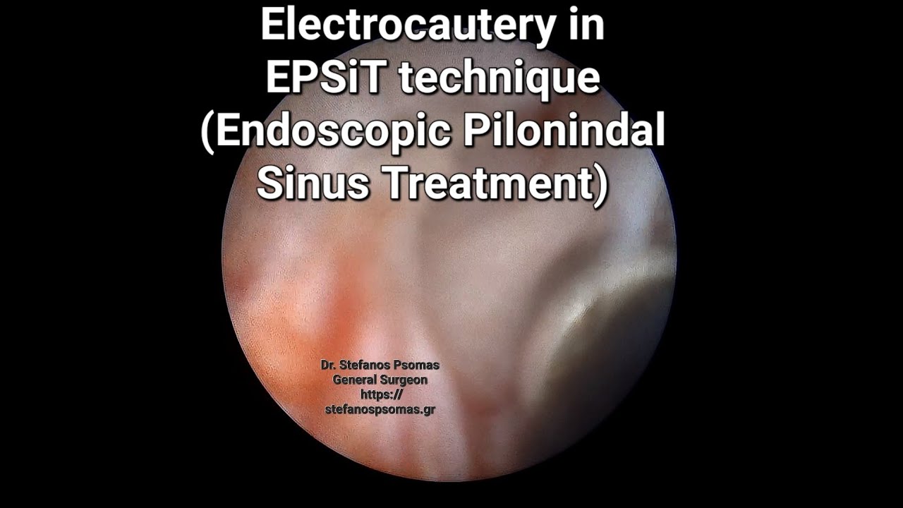 Endoscopic Pilonindal Sinus Treatment (EPSiT). Electrocautery part of ...