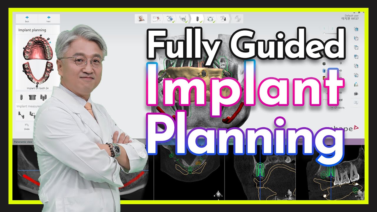 [DIGITAL DENTISTRY] Fully Guided Implant Planning Using Implant Studio ...