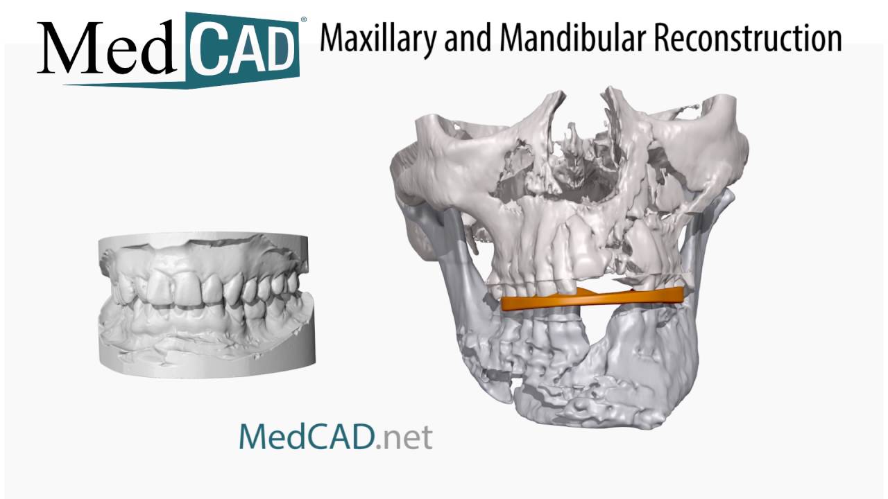 Maxillary and Mandibular Reconstruction with Occlusal Splints - YouTube