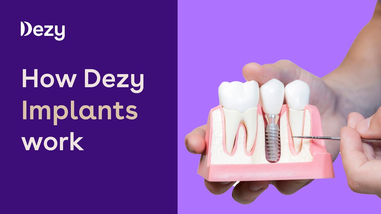 How Dezy Implants Work? - YouTube
