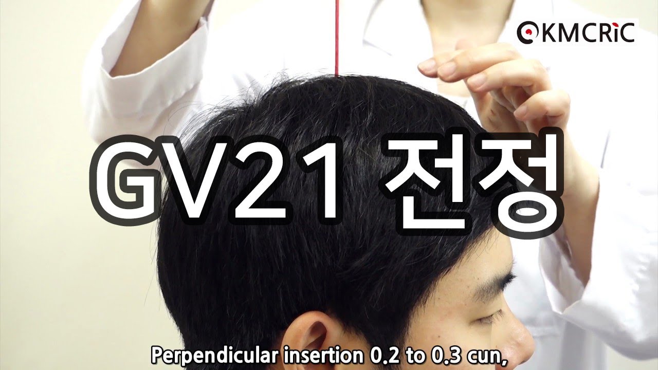 GV21 전정 前頂 Qianding (Eng sub) - KMCRIC WHO Standard acupoint DB - YouTube
