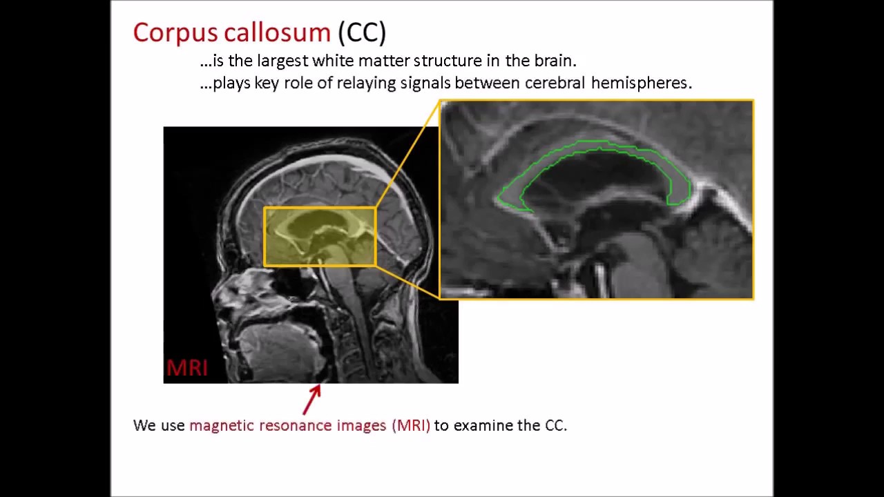 MICCAI 2015 - Corpus Callosum Segmentation via Extrinsic_Intrinsic Cues ...