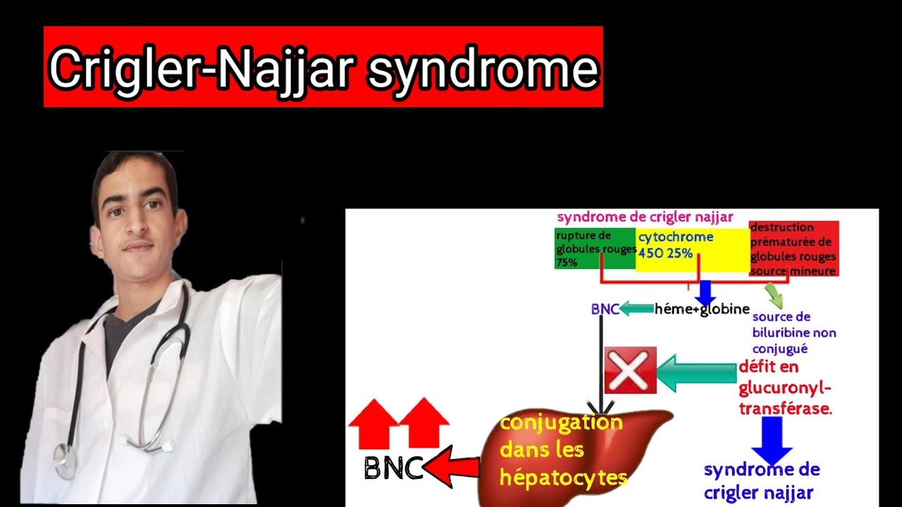 Crigler-Najjar syndrome - YouTube